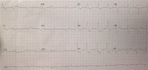 Phimaimedicine 483 Complete Right Bundle Branch Block