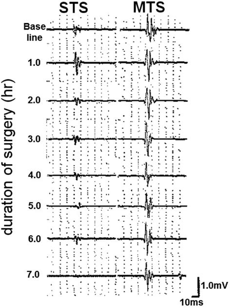 The Trial To Trial Variability Of Transcranial Motor Evoked Potentials