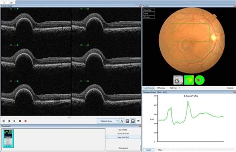 PED Due To CSCR Retina Image Bank