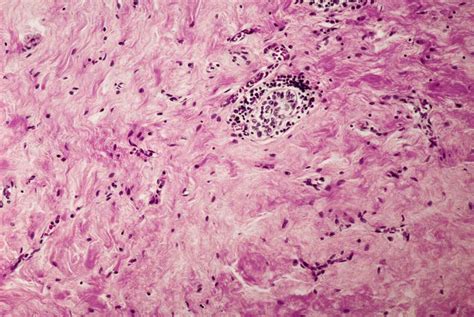 Facts About Turner Syndrome Facts Net