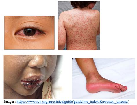 What Is Kawasaki Disease Symptoms Causes Diagnosis And More Chiid Health