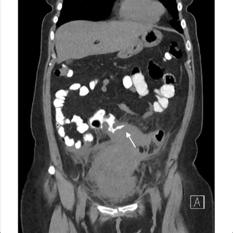 Colonoscopy Showing An Infiltrative Partially Obstructing Large Mass Download Scientific