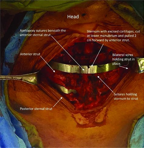 Operative Picture Of Repair Fig 4 Post Operative VQ Scan Showing Download Scientific Diagram