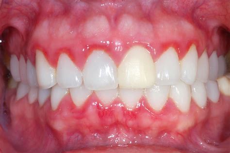 Gengivite Zona Sul Sp Odontologia Apeles Lemos 5563 5471