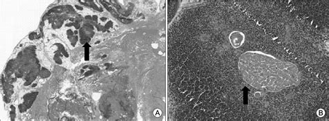 Figure 2 From A Case Of Ectopic Lateral Cervical Thymic Cyst Mimicking As A Second Branchial
