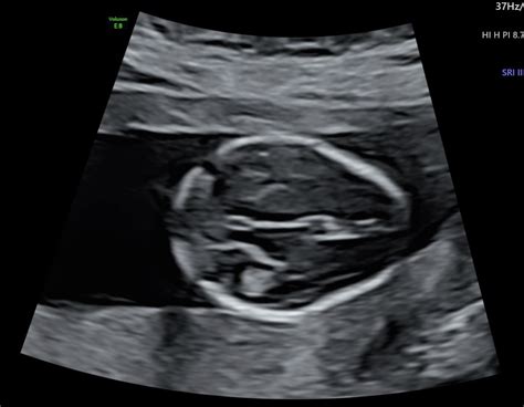 Nuchal Translucency Scans Early Anatomy Scans — Trinity Imaging