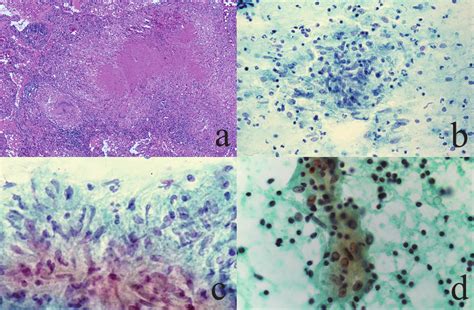 Granulomatous Inflammation Against Mycobacterium Tuberculosis A