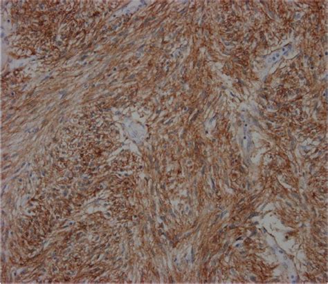 Note The Positivity Of Tumor Cells To Markers C Kit Cd117 In