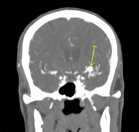 Ct Scan And Mri Ct Brain Aneurysm