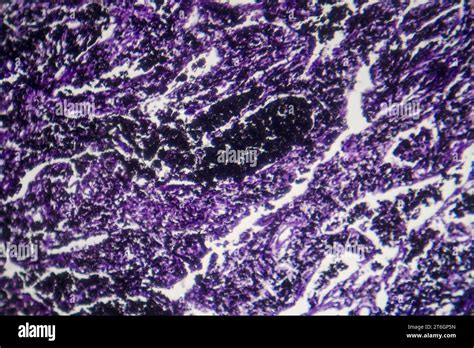 Photomicrograph Of Silicosis Revealing Lung Tissue Scarring And Inflammation Caused By Inhaling