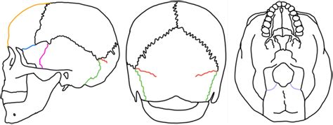 Normal Developmental Sutures And The Age By Which Suture Closure Can Be