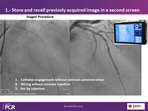 Low Contrast Complex PCI In A Severely Calcified Lesion The Right Tools And Techniques