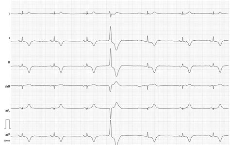 Sinus Bradycardia And More Ecg Guru Instructor Resources