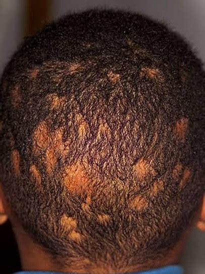 SCALP INFECTION