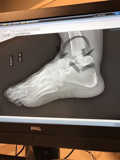 Talus Fracture And Partial Displacement Healing Advice And Support