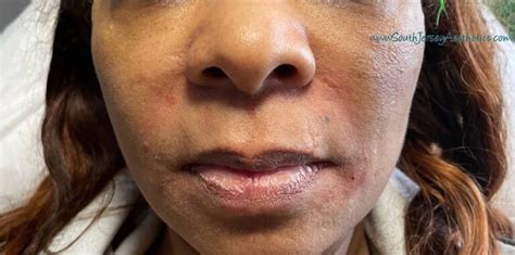 Nasolabial Fold Fillers South Jersey Aesthetics