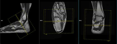Peroneal Tendon Mri Protocol And Planning