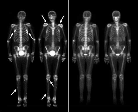 Voriconazole Induced Periostitis Pediatric Patients Bone Arrow