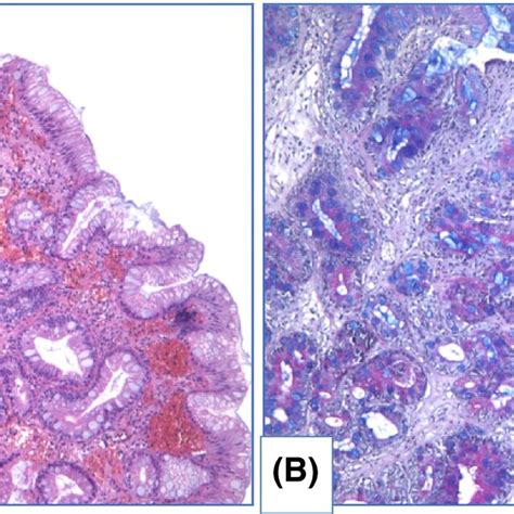 Invasive Adenocarcinoma Of Distal Esophagus Specimen Of Malignant