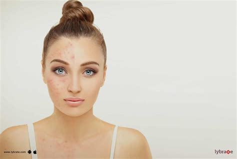 Hyperpigmentation And Scars Ways Laser Treatment Can Help By Dr Nitin Jain Lybrate