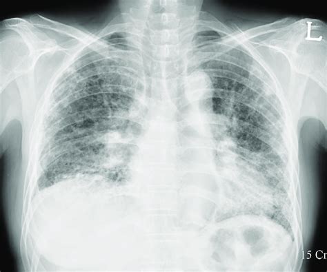 Pulmonary Fibrosis Associated With Progressive Systemic Sclerosis In A Download Scientific