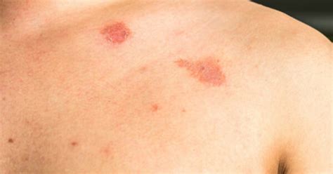 Soppinfeksjon På Huden Velbehag Medisinsk Hudklinikk