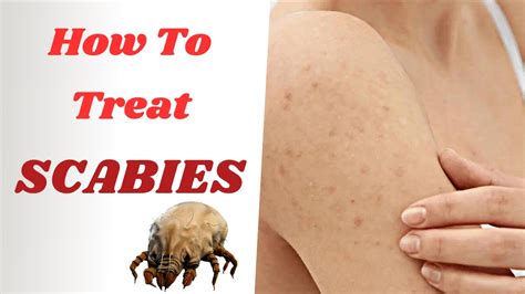 How To Treat Scabies Effectively From Permethrin Cream To Ivermectin