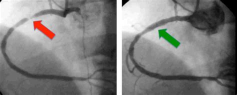 No More Blockages How Ptca Improves Heart Function Abdi Waluyo Hospital