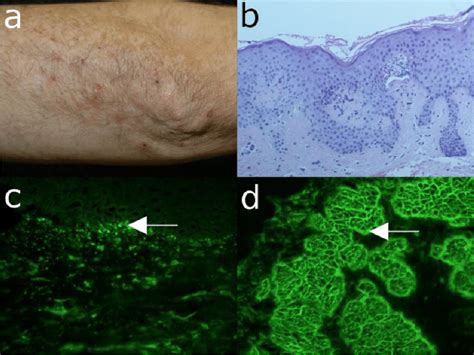 Pathogenesis Of Epidermolysis Bullosa Acquisita