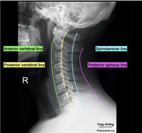 Spinal Radiology Flashcards Quizlet