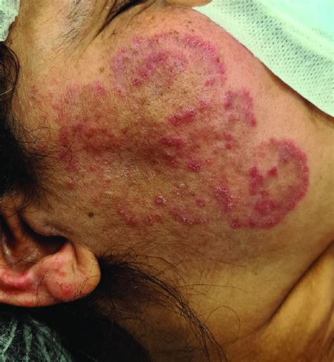 Clinical Image Of The Erythematous Annular And Pruritic Macules With Download Scientific