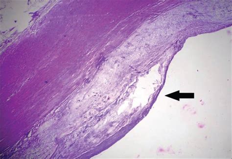 Microphotograph Showing Aortic Thin Fibrous Cap Atheroma Arrow H And Download Scientific