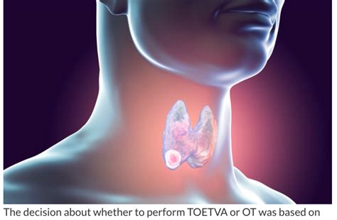 Transoral Thyroid And Parathyroid Surgery News