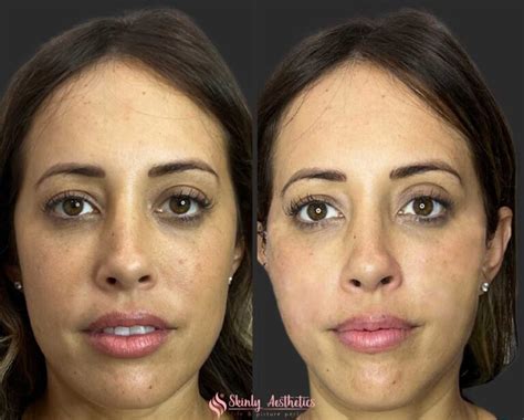 Pdo Thread Lifting Before And After Results At Skinly Aesthetics