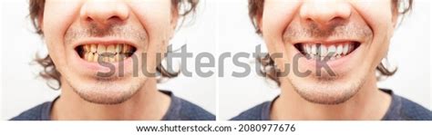 Ugly Teeth Before And After Braces