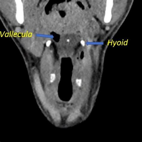 Vallecular Cyst In An Adult Patient Eurorad