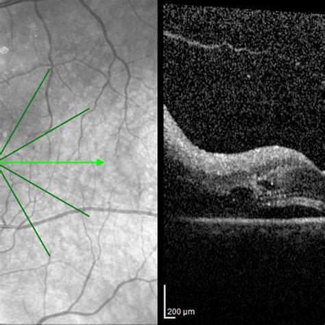 Left Eye Swollen Optic Disc Subfoveal Subretinal Fluid Extending To Download Scientific