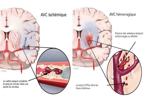 40 Ans De Progrès En Cardiologie Chapitre 7 Laccident Vasculaire