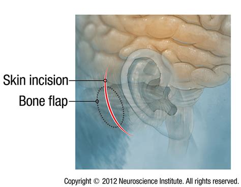 Trigeminal Neuralgia Surgery Specialists Trigeminal Neuralgia Treatment