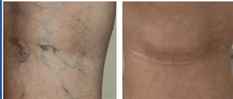 Veins Treatment Shiloh Medical Clinic