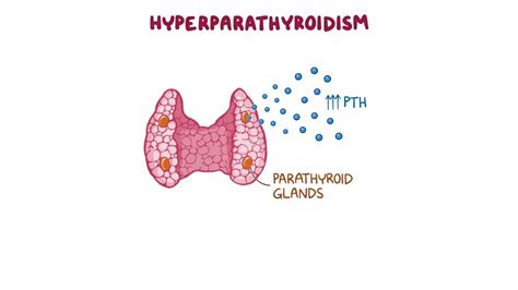 Hyperparathyroidism Clinical Sciences Osmosis Video Library