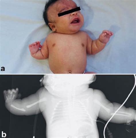 1a Infants Face With No Dysmorphic Features 1b Extremity Anomalies