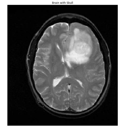 Python Mri Brain Tumor Image Processing And Segmentation Skull Removing Stack Overflow