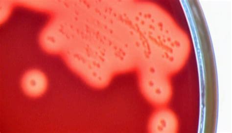 Invasive Strep Infections Rising In Canada What To Know Canada News Media