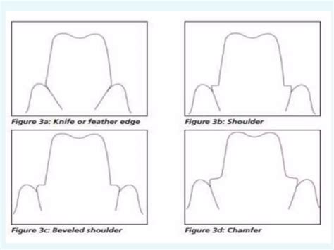 Design Of A Fixed Partial Denture With Abutment Tooth Preparation Pptx