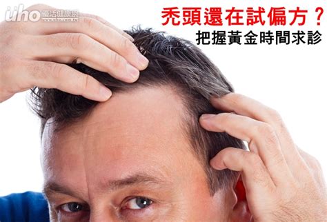 禿頭還在試偏方？把握黃金時間求診 Uho優活健康網