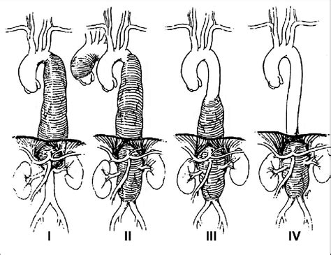 1 Crawfords Classification System Of Thoraco Abdominal Aortic Aneurysms Download Scientific