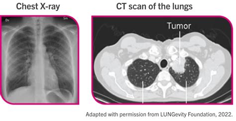 What Is Advanced Nsclc Libtayo® Cemiplimab Rwlc