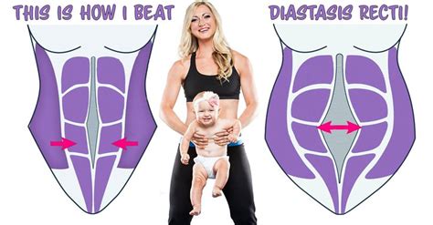 Diastasis Recti Also Referred To As ‘divarication Of The Recti Dra Or ‘rectus Divarification