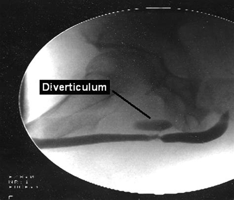 Urethral Diverticulum After Endoscopic Urethrotomy Case Report Urology